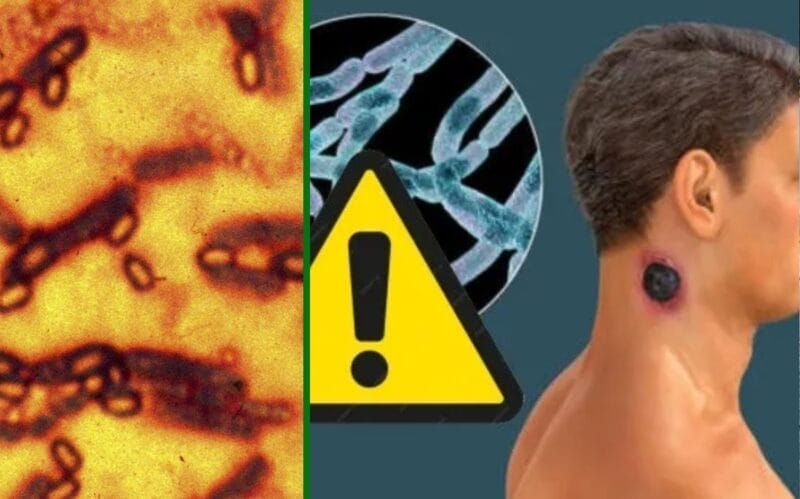 OMS alerta sobre posible brote de ántrax; ¿cómo se contagia y cuáles ...